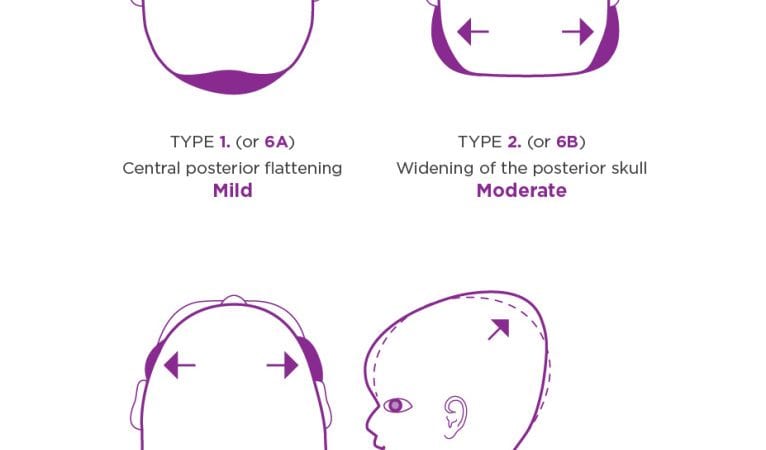 What is Brachycephaly and What Causes it?